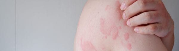 Understanding and Addressing the Kratom Rash
